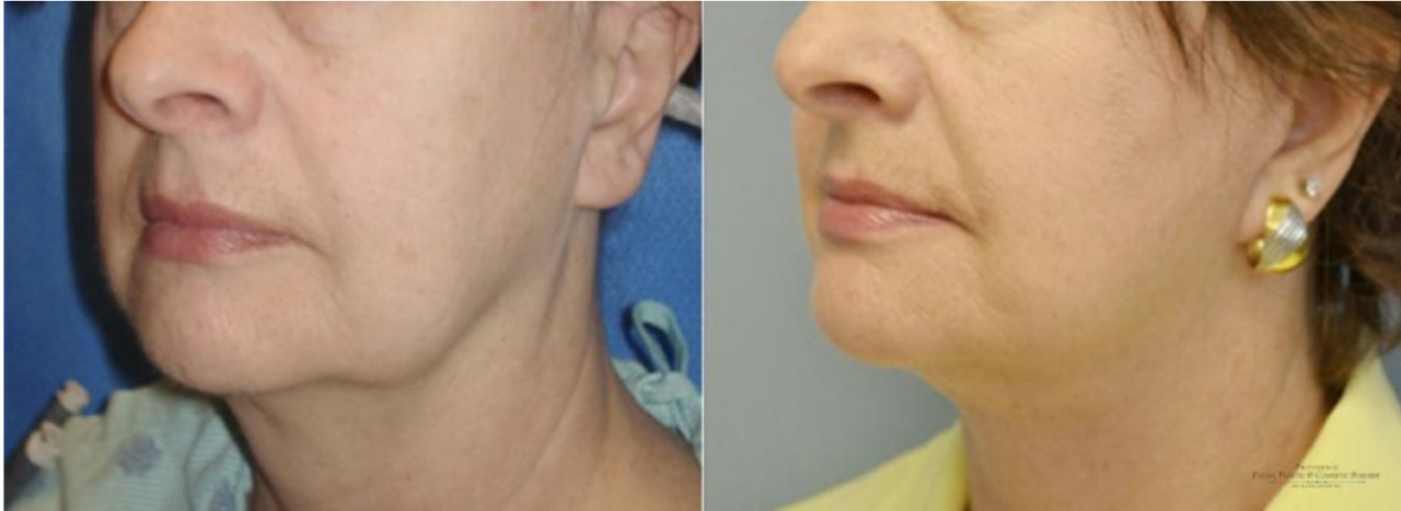 Scar Revision in Philadelphia, PA | Providence Cosmetic Surgery